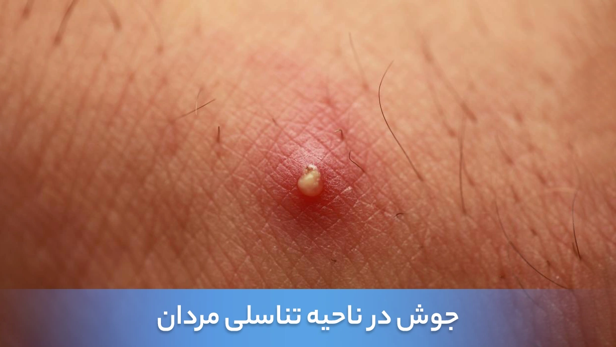 جوش در ناحیه تناسلی مردان، دلایل و درمان پیکاطب